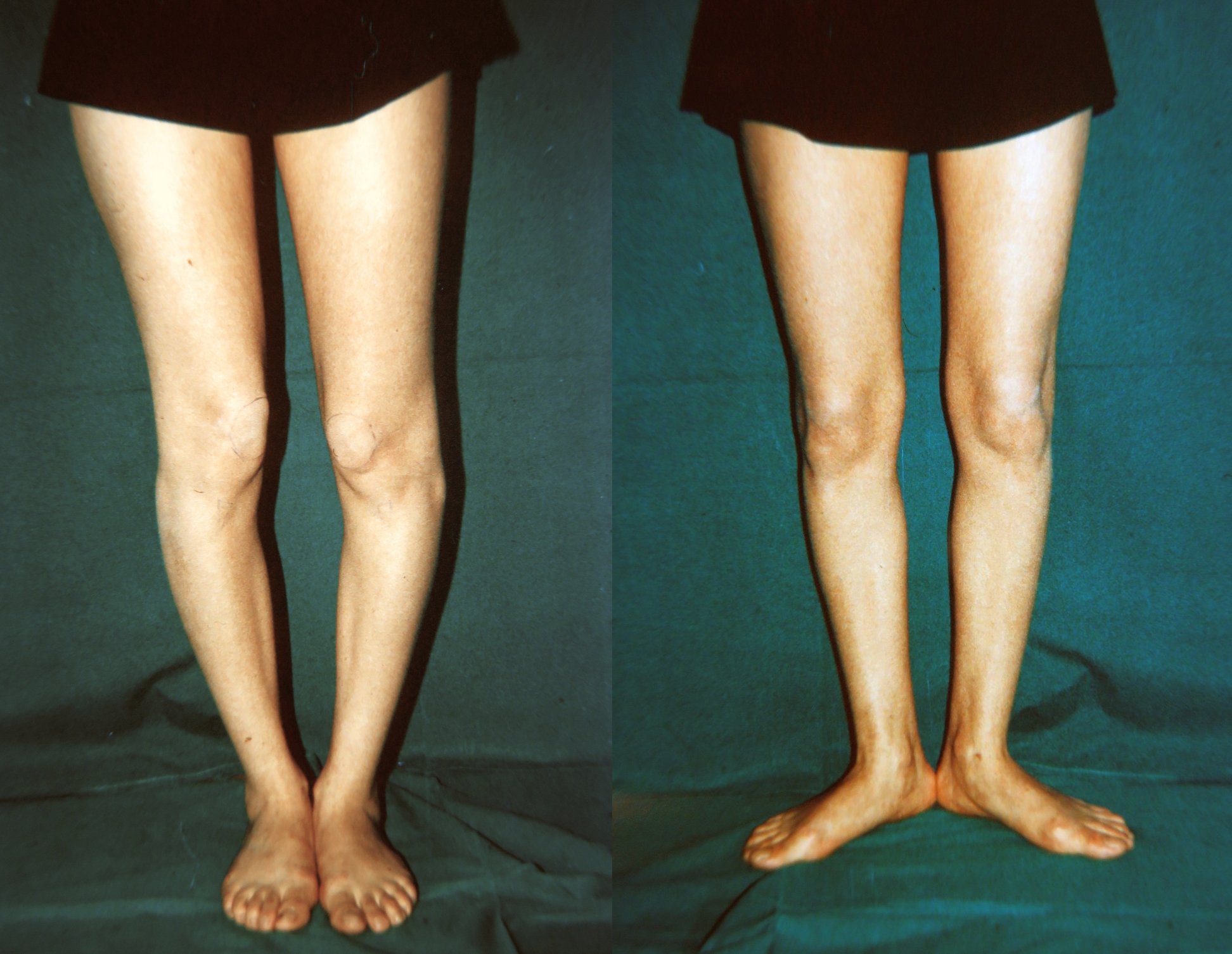 Anomalia torsionale congenita: la tripla deformazione di Judet - Dr ...